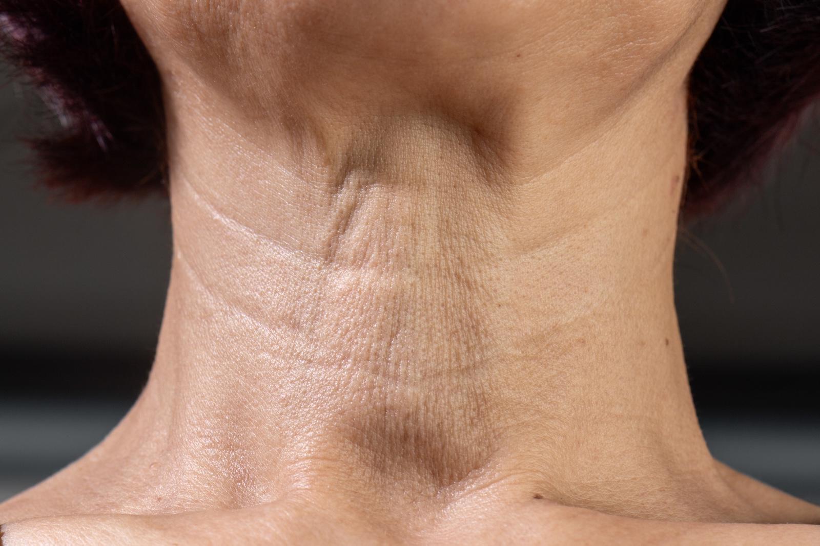 Neck Lift Surgery Melbourne | Surgical Neck Tightening | Platysmaplasty